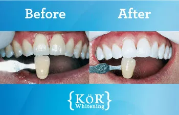 KöR Whitening Scottsdale, AZ | Professional Whitening | Pinnacle Peak ...